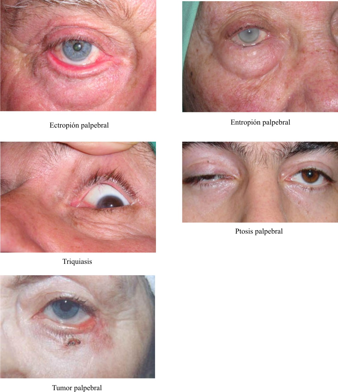 Cirugía palpebral | Benisek Ascarza